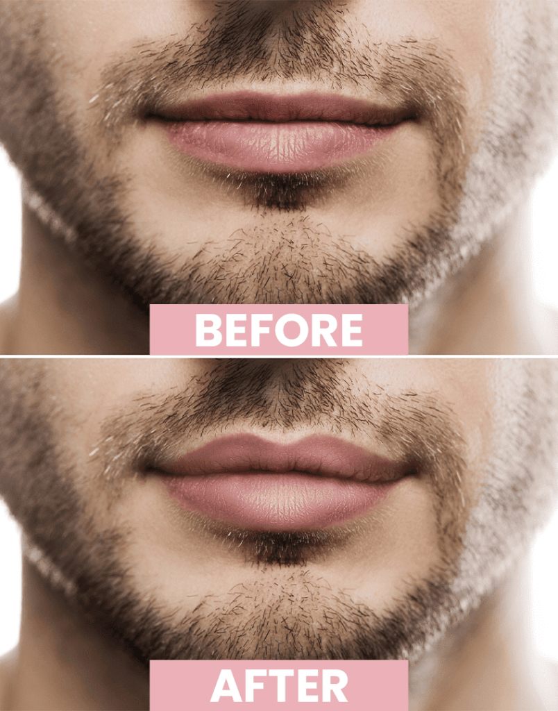 Lip Fillers for Men: Things to Consider [2023 Guide]