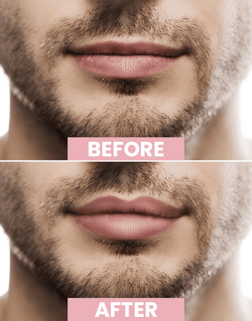 Lip Fillers for Men: Things to Consider [2023 Guide]